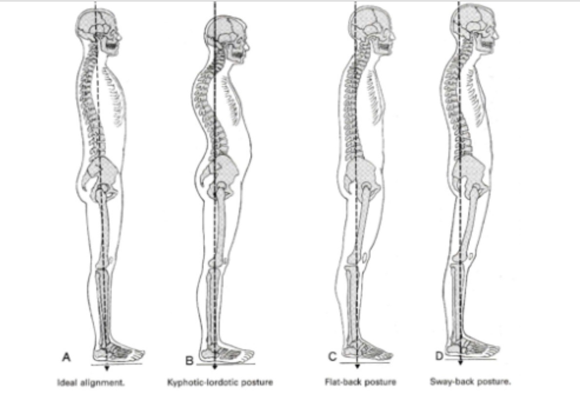 4 Steps to Improve your Posture | J F Muscle Medic
